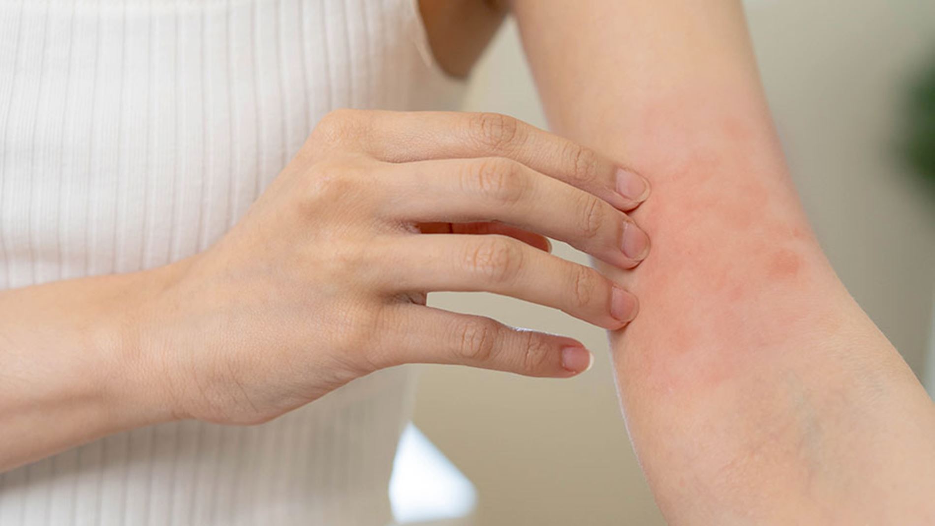 Невродермит: Дерматолог разказва повече за заболяването |ACTIVE BEAUTY